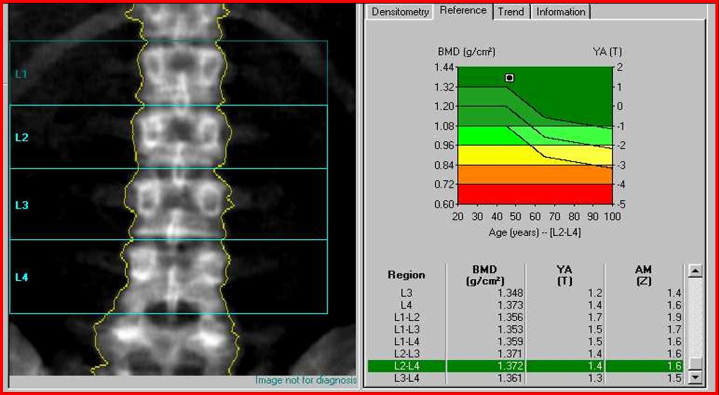 Osteoporosis Centro Ginecologico Escalante